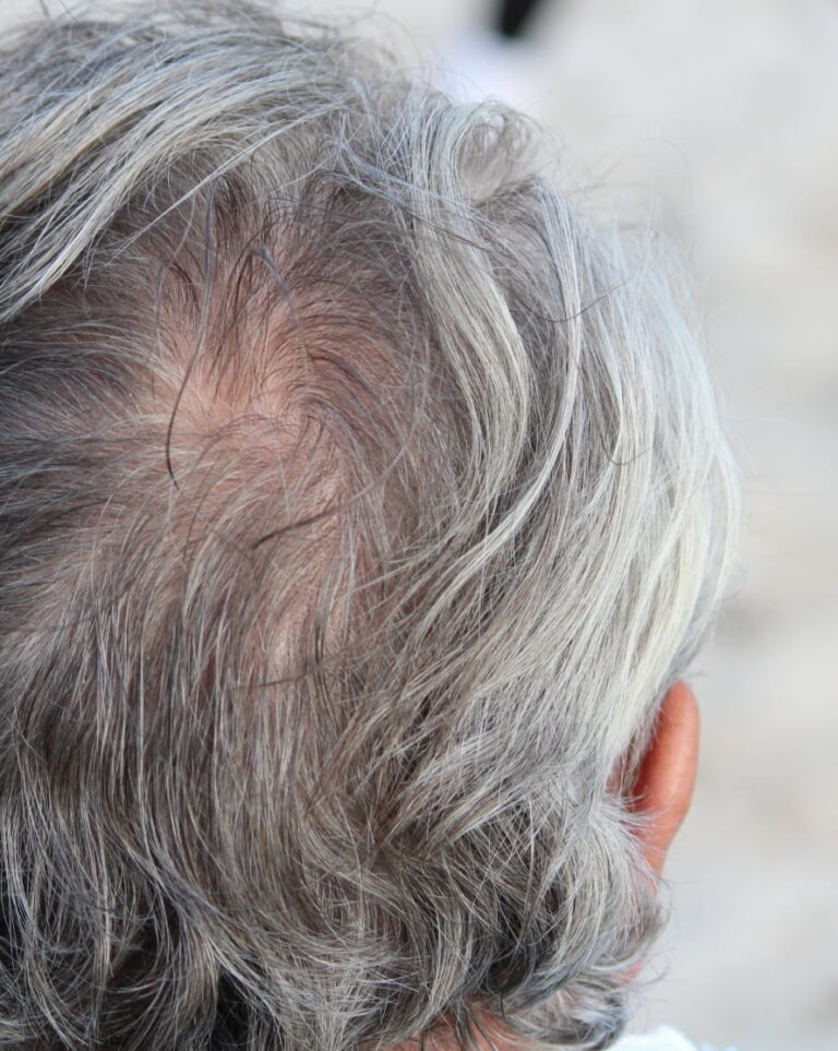 Chute & Perte De Cheveux Chez L'homme Centre Clauderer | Alopécie ...